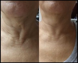 Before and after photos - Brightcore Revive Collagen - HBN Show